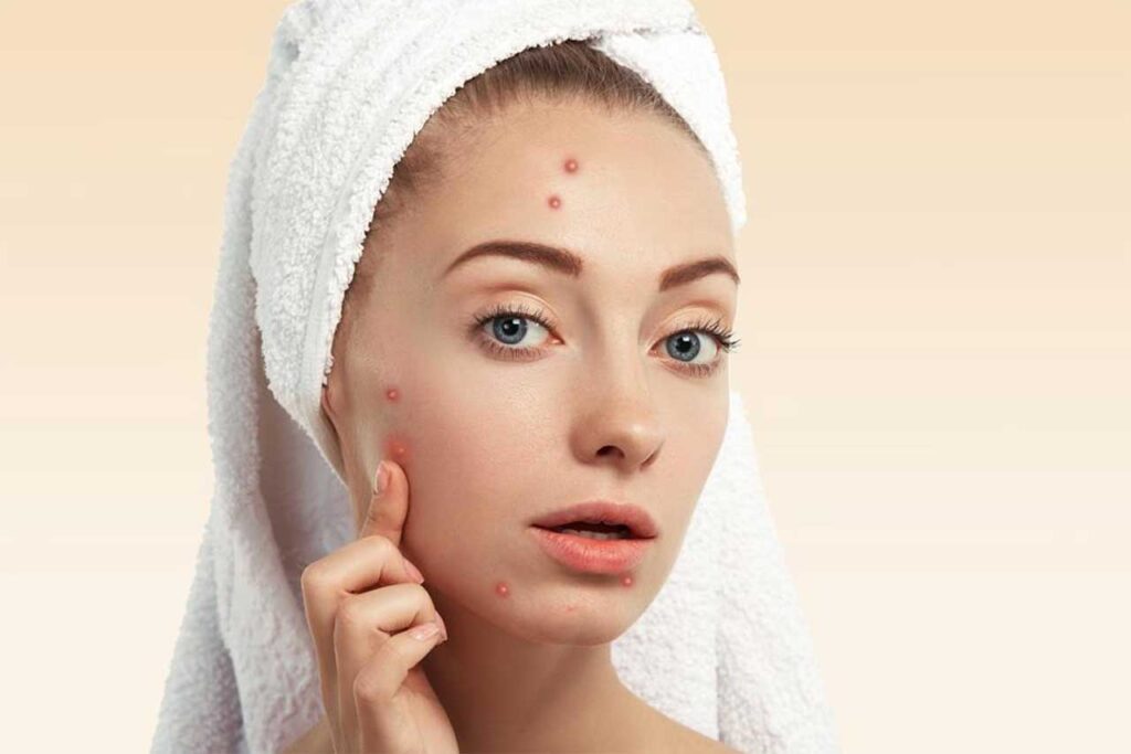 Sun And Pimples ; Fighting Pimples