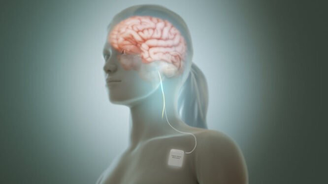 Deep Brain Stimulation - DBS