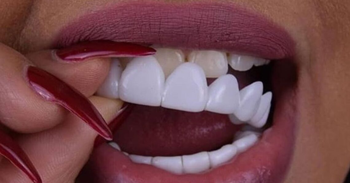 Types Of Veneers: Traditional To Minimal-Prep – A Guide