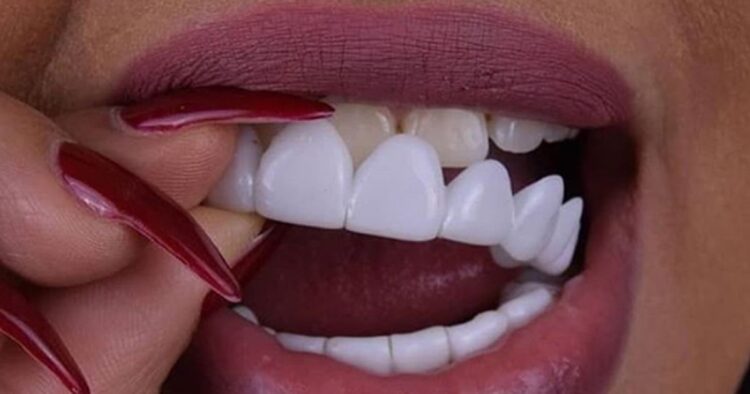 Types Of Veneers: Traditional To Minimal-Prep – A Guide