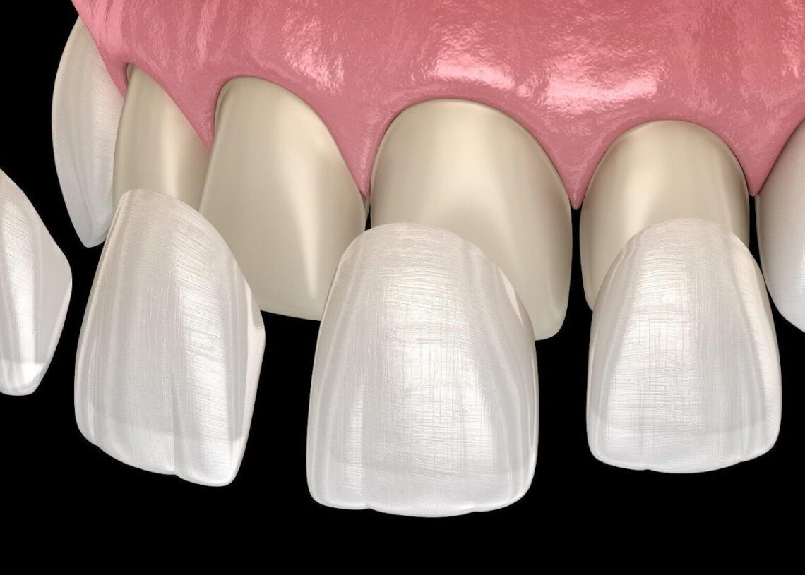 Types Of Veneers: Traditional To Minimal-Prep – A Guide